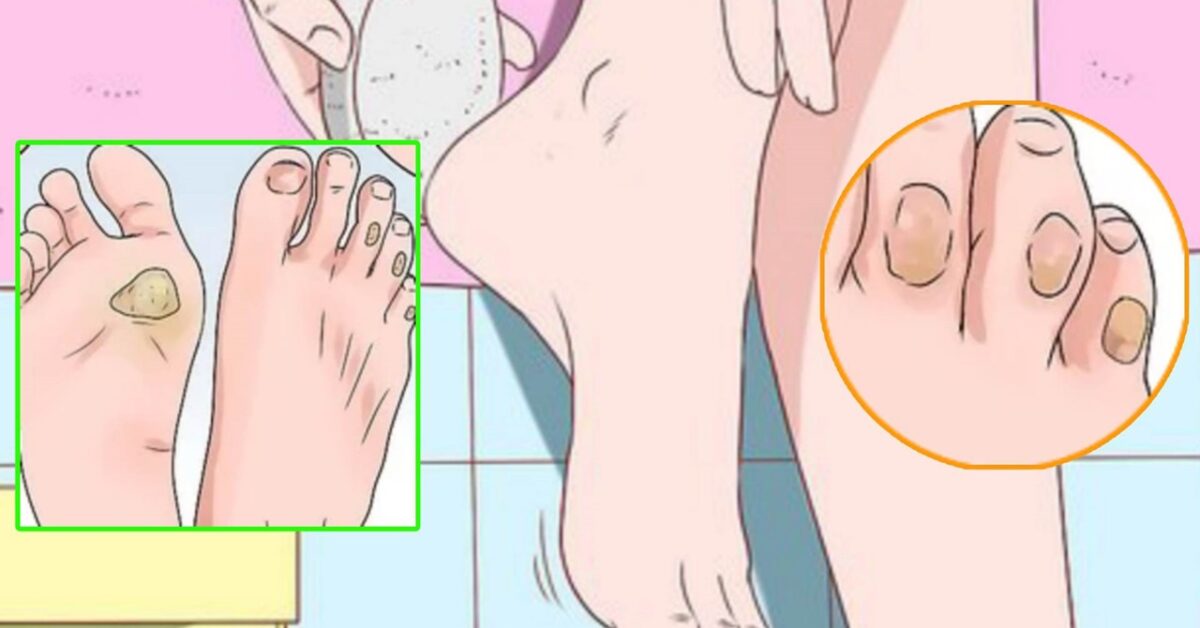 The Natural Remedy to Get Rid of Calluses and Corns on the Feet