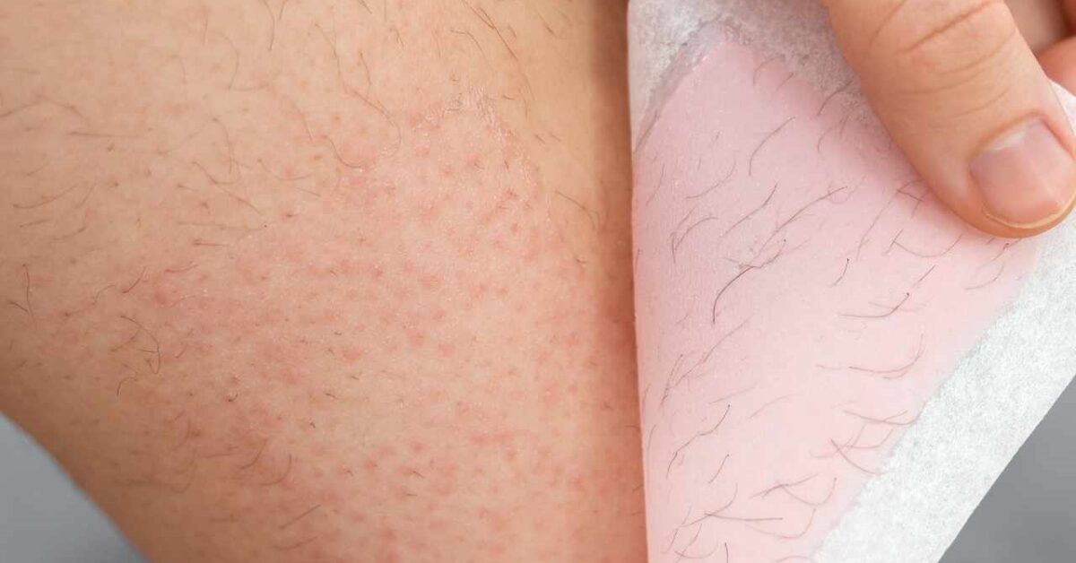 Ingrown Hairs, the Remedies to Get Rid of Them