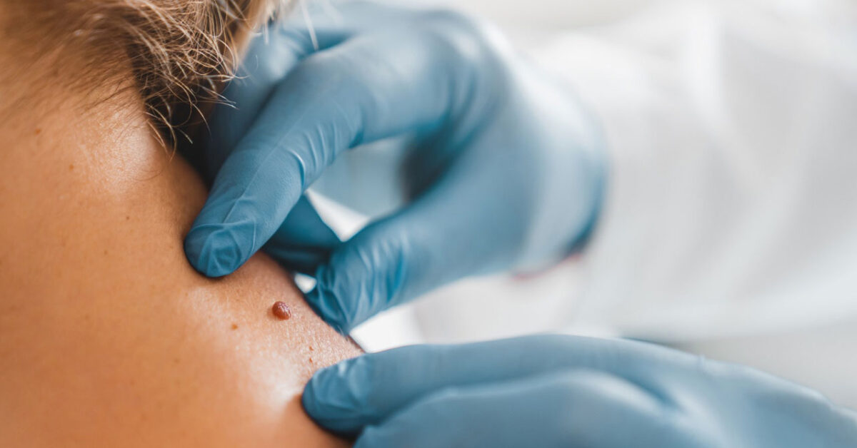 What are Skin Tags and How to Remove Them